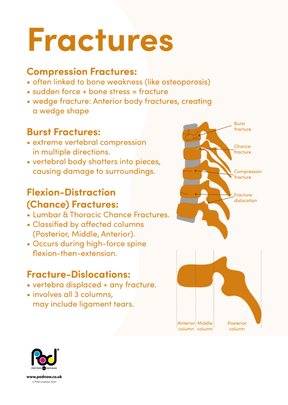 Fractures | POD | Posters On Demand